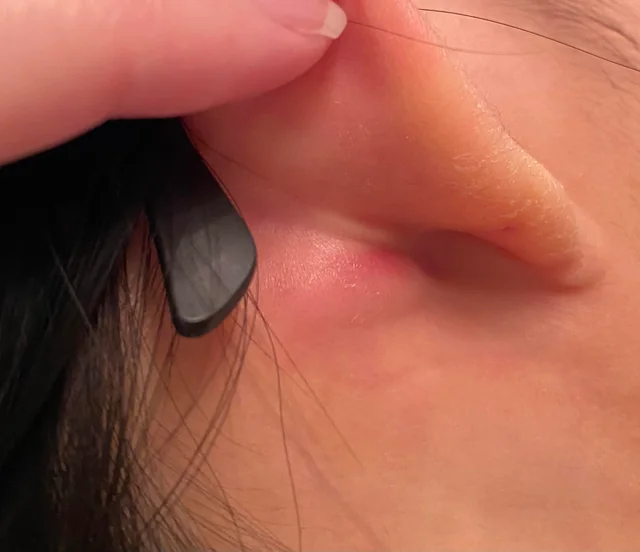 Painless Lump Behind Ear: Causes, Symptoms & When to Worry